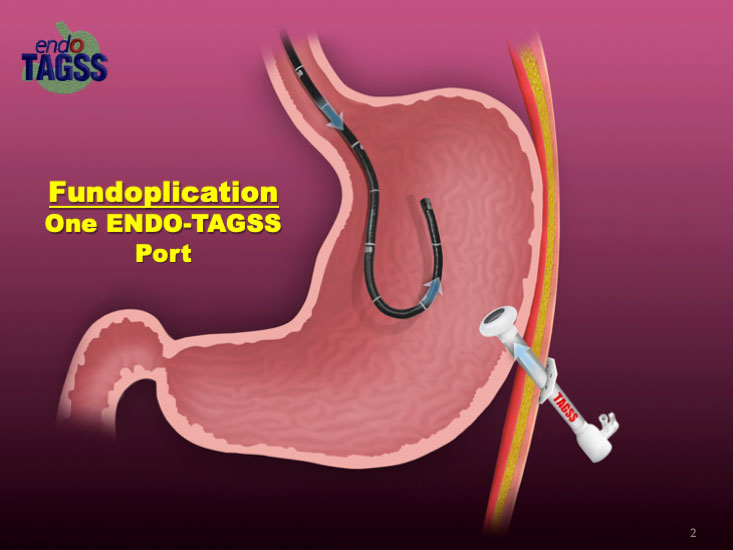 TAGSS - Trans-Abdominal Gastric Surgical System